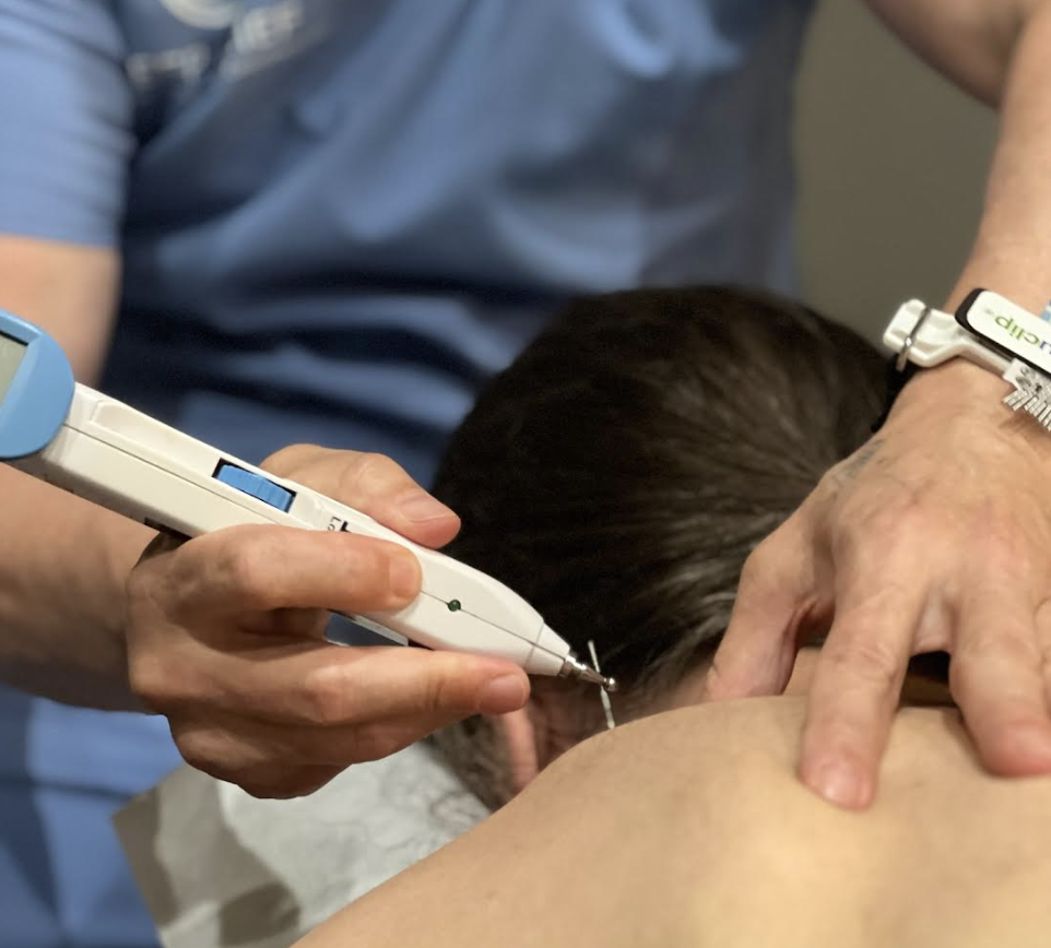 Did You Know: Dry Needling | DEEP Relief